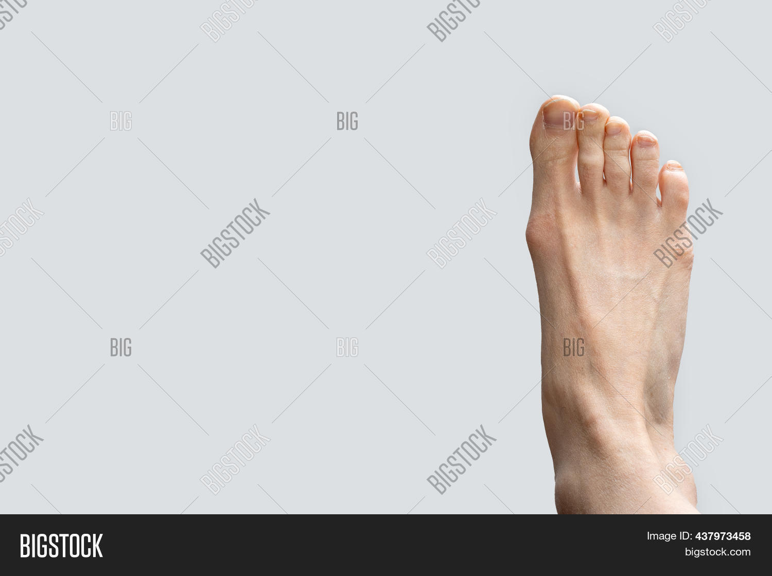 Hallux Valgus, Image & Photo (Free Trial) | Bigstock