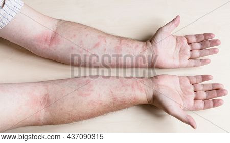Sample Allergic Image & Photo (Free Trial) | Bigstock