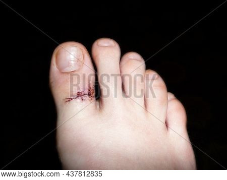 Surgical Suture On Big Image & Photo (Free Trial) | Bigstock