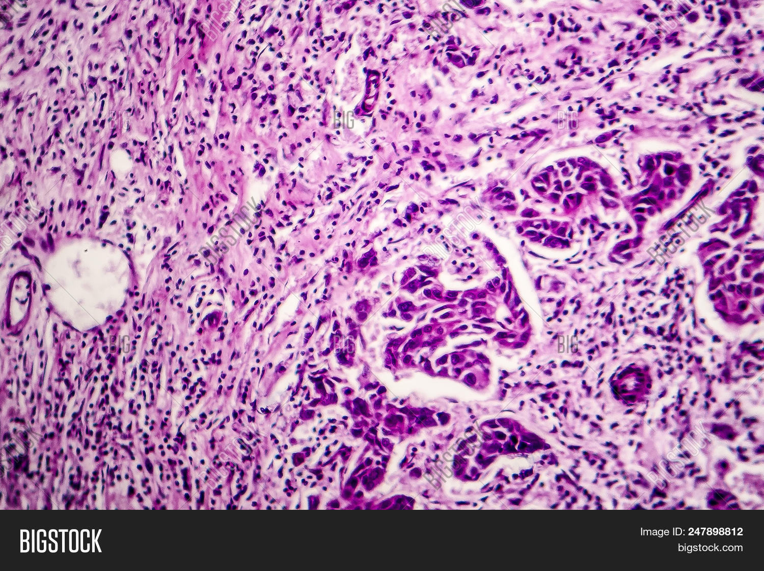 Lymph Node Metastasis Image & Photo (Free Trial) | Bigstock