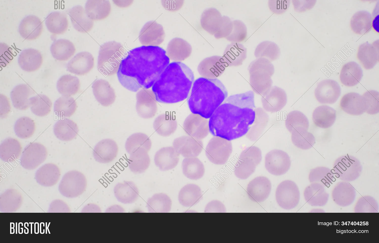 Blast Cell Leukemia Image & Photo (Free Trial) | Bigstock