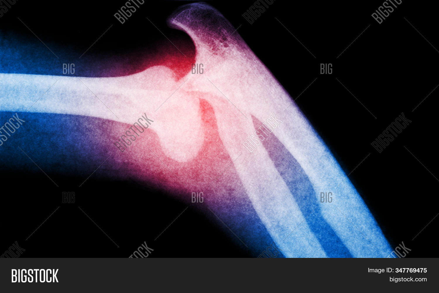 X Ray Bone Scan. Image & Photo (Free Trial) | Bigstock