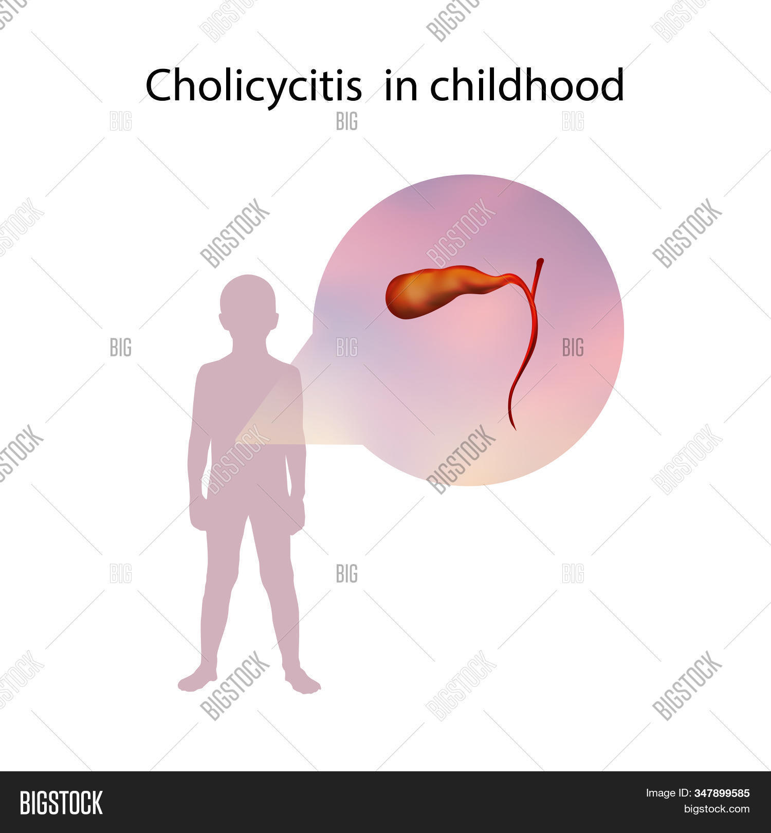 Cholecystitis Image & Photo (Free Trial) | Bigstock