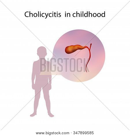 Cholecystitis Image & Photo (Free Trial) | Bigstock