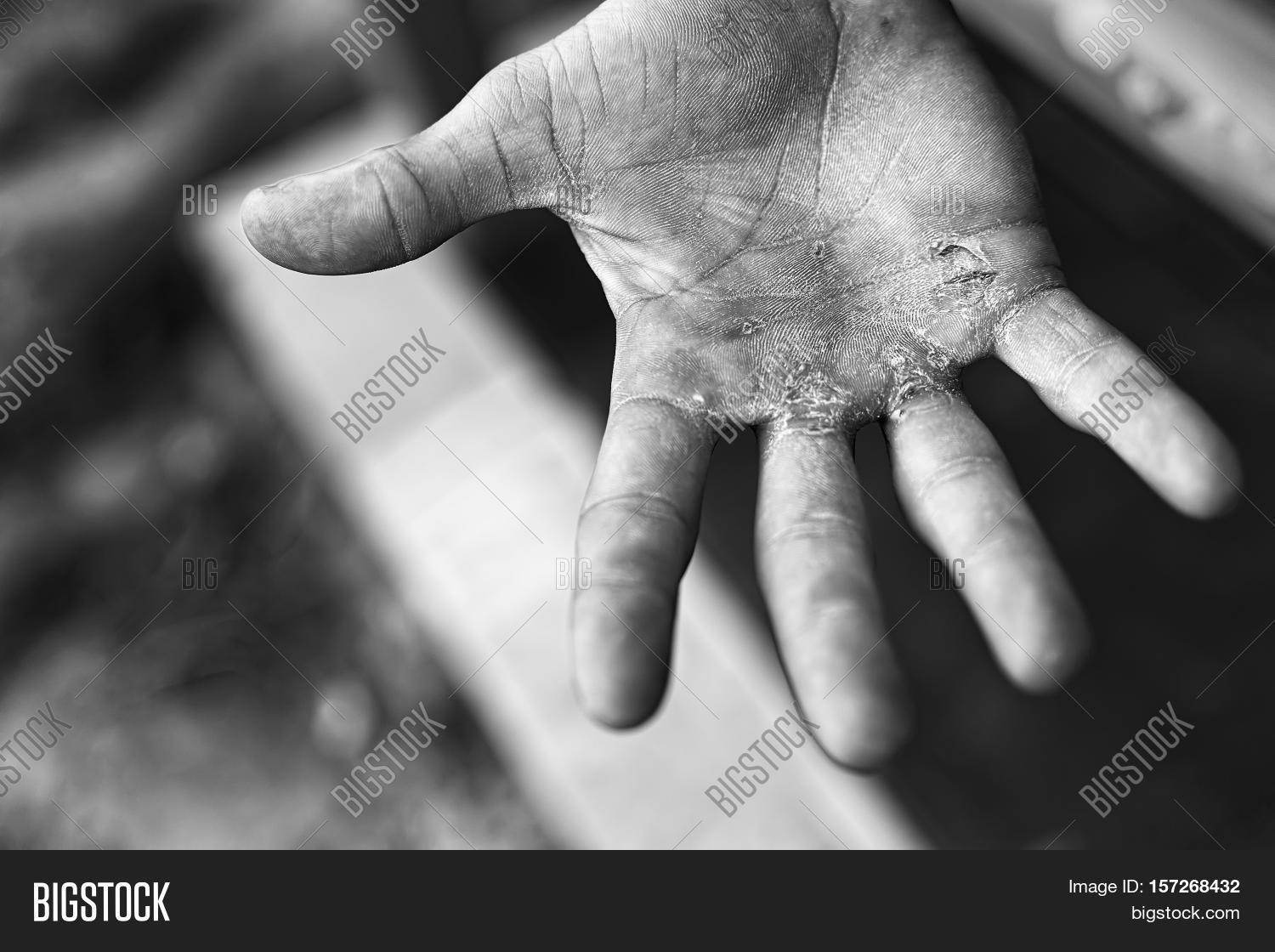 Palm Calluses. Hard Image & Photo (Free Trial) | Bigstock