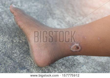 Infected Wound On Leg Image & Photo (Free Trial) | Bigstock