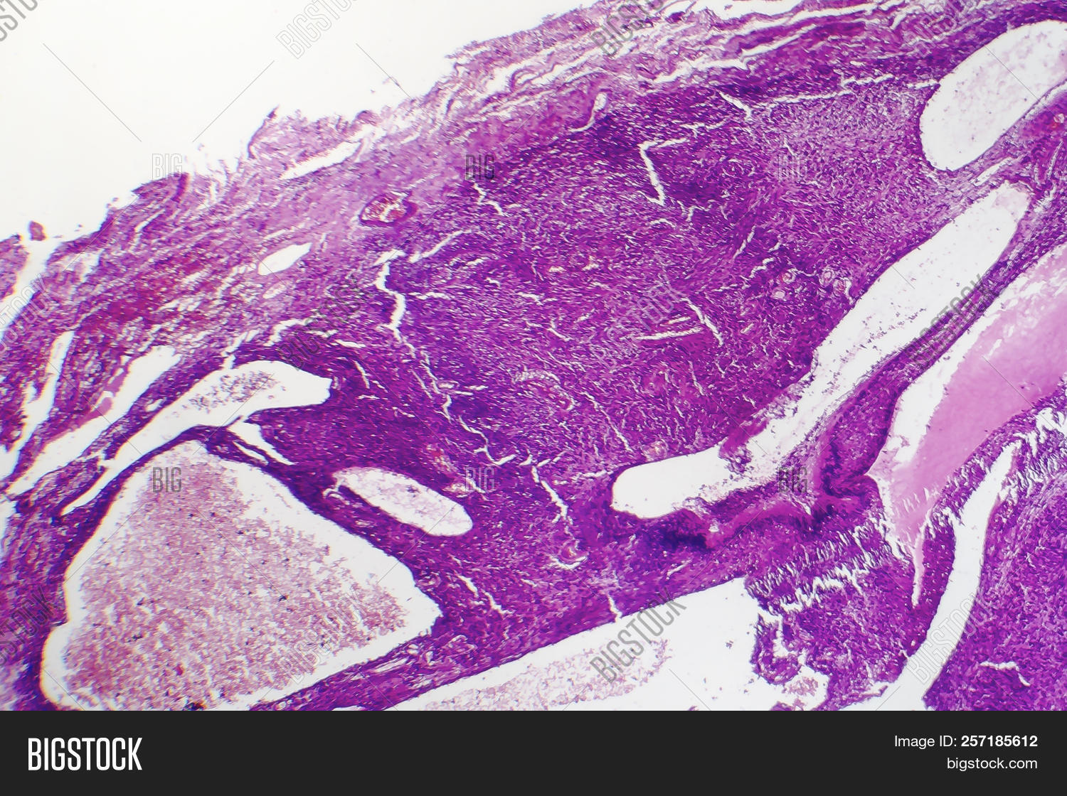 Fibrosarcoma, Image & Photo (Free Trial) | Bigstock