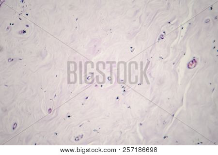 Fibroadenoma, Benign Image & Photo (Free Trial) | Bigstock