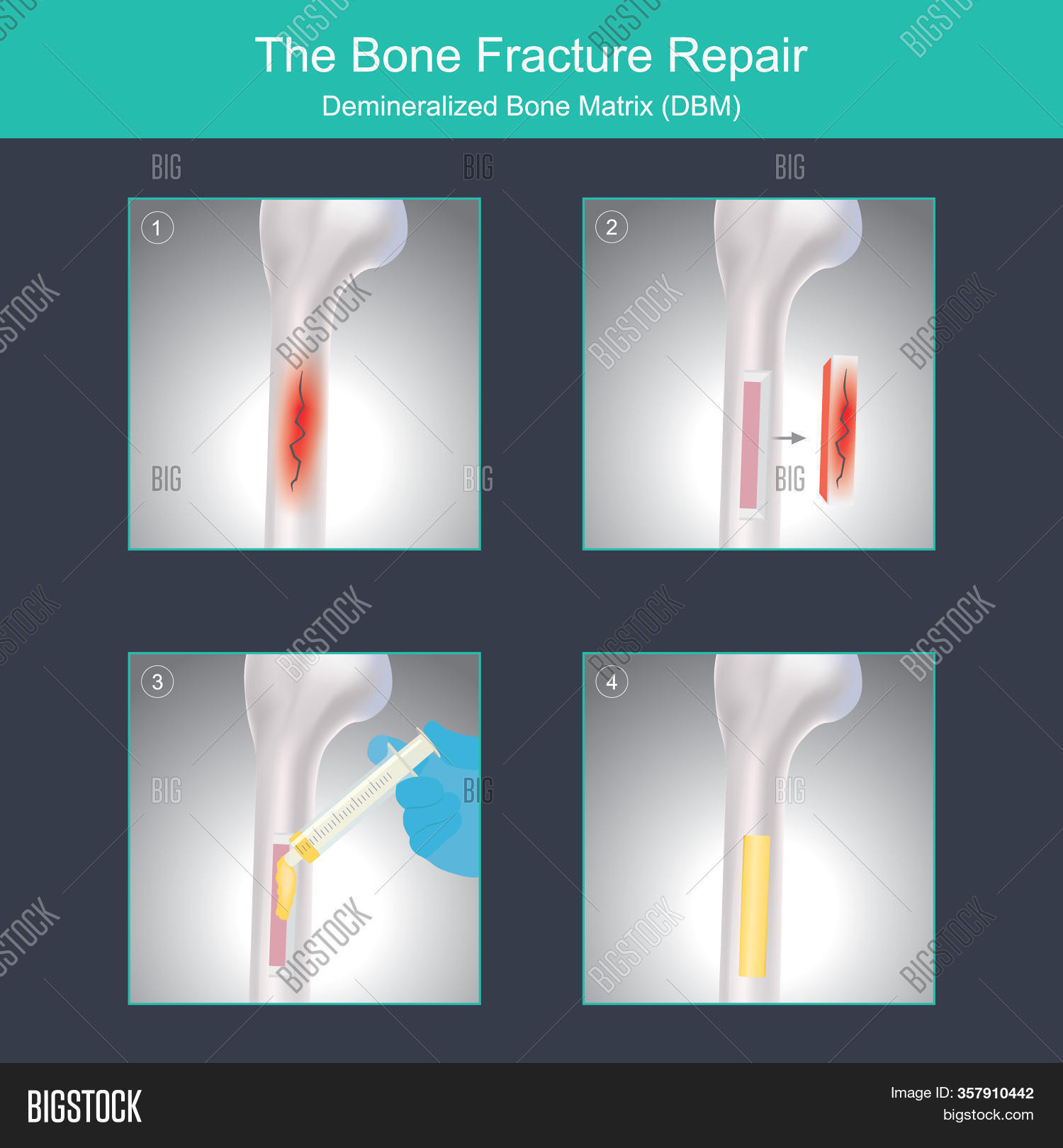 Bone Fracture Repair. Image & Photo (Free Trial) | Bigstock