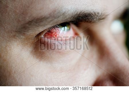 Closeup Red Eye Image & Photo (Free Trial) | Bigstock