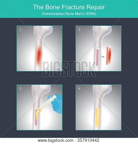 Bone Fracture Repair. Image & Photo (Free Trial) | Bigstock