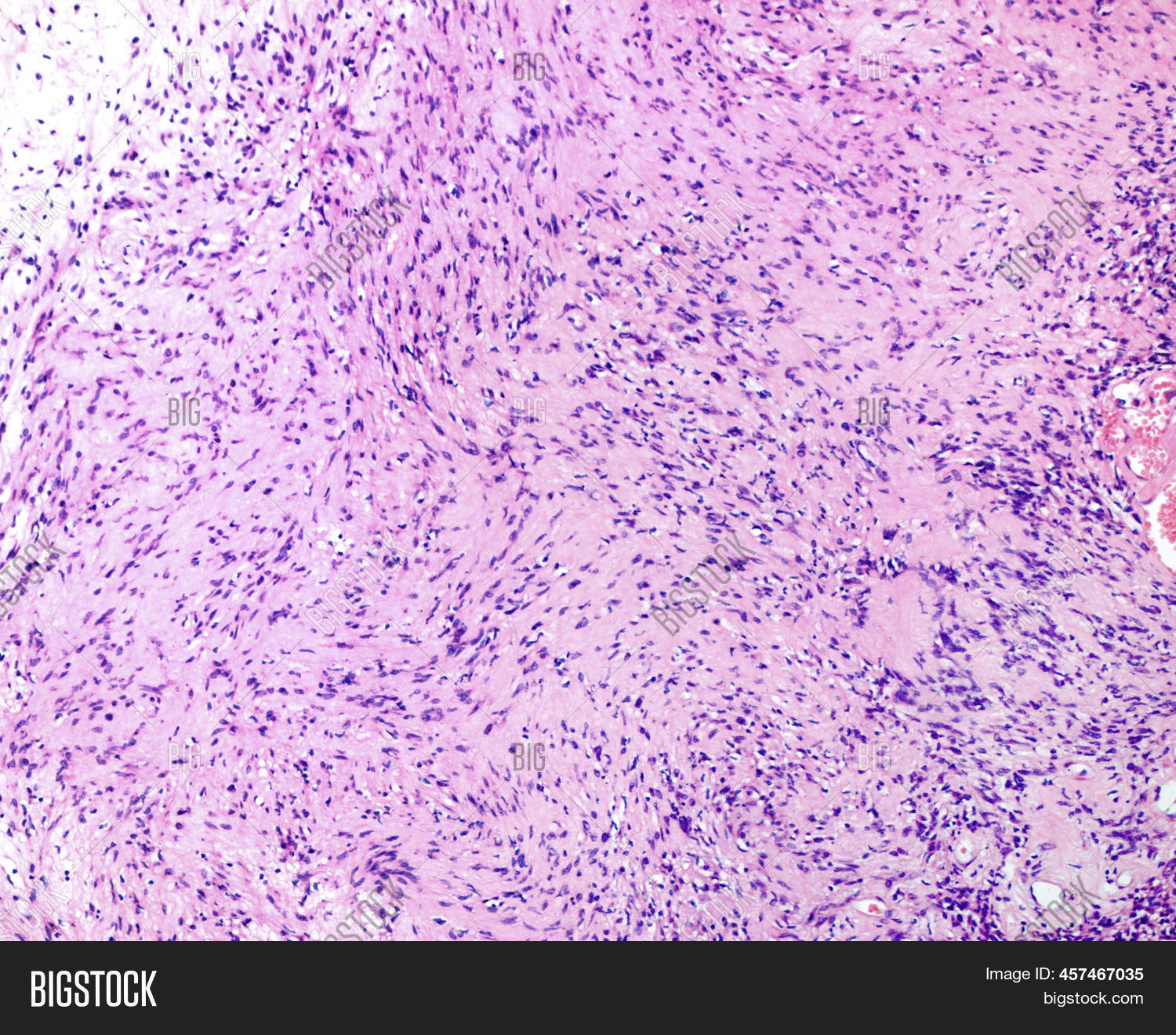 Neurilemmomas Image & Photo (Free Trial) | Bigstock