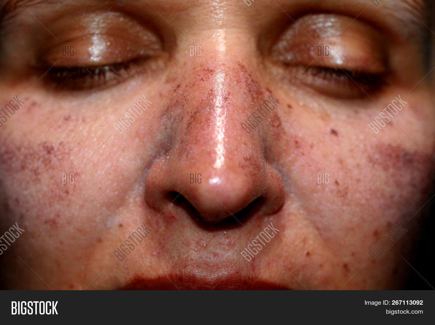 Pigmented Spots On Image & Photo (Free Trial) | Bigstock
