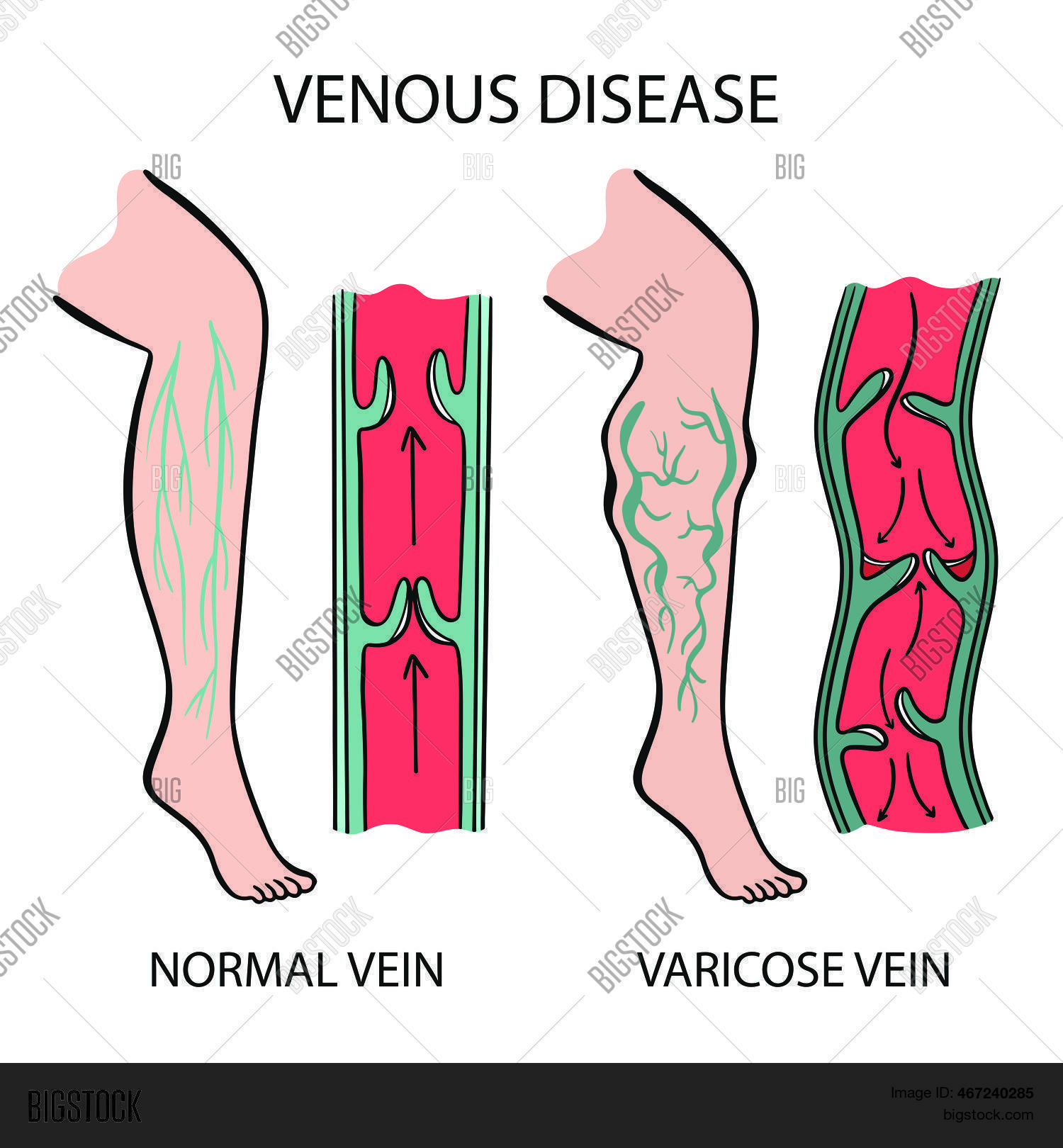 Venous Disease Vector & Photo (Free Trial) | Bigstock
