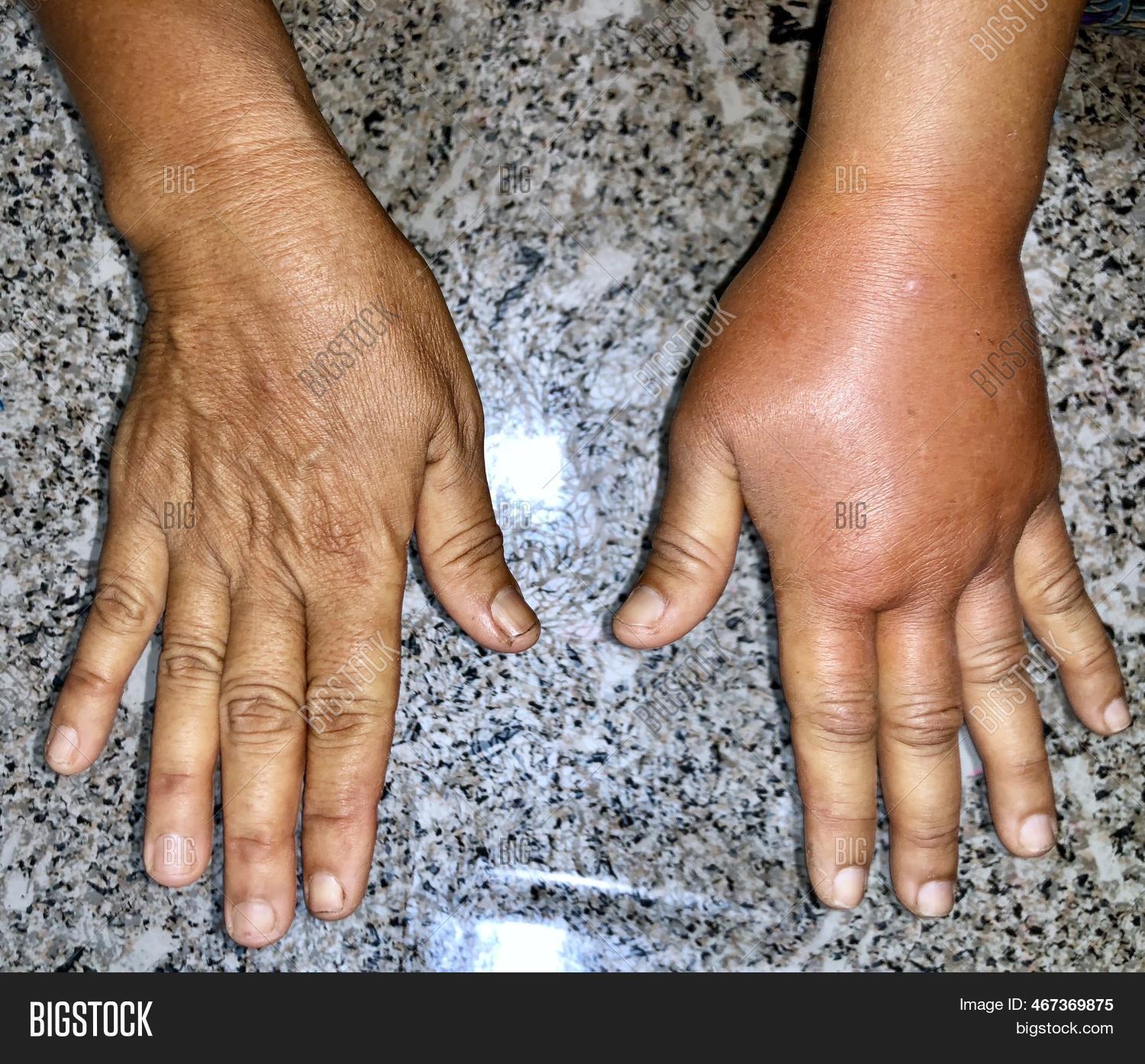 Unilateral Edema Upper Image & Photo (Free Trial) | Bigstock