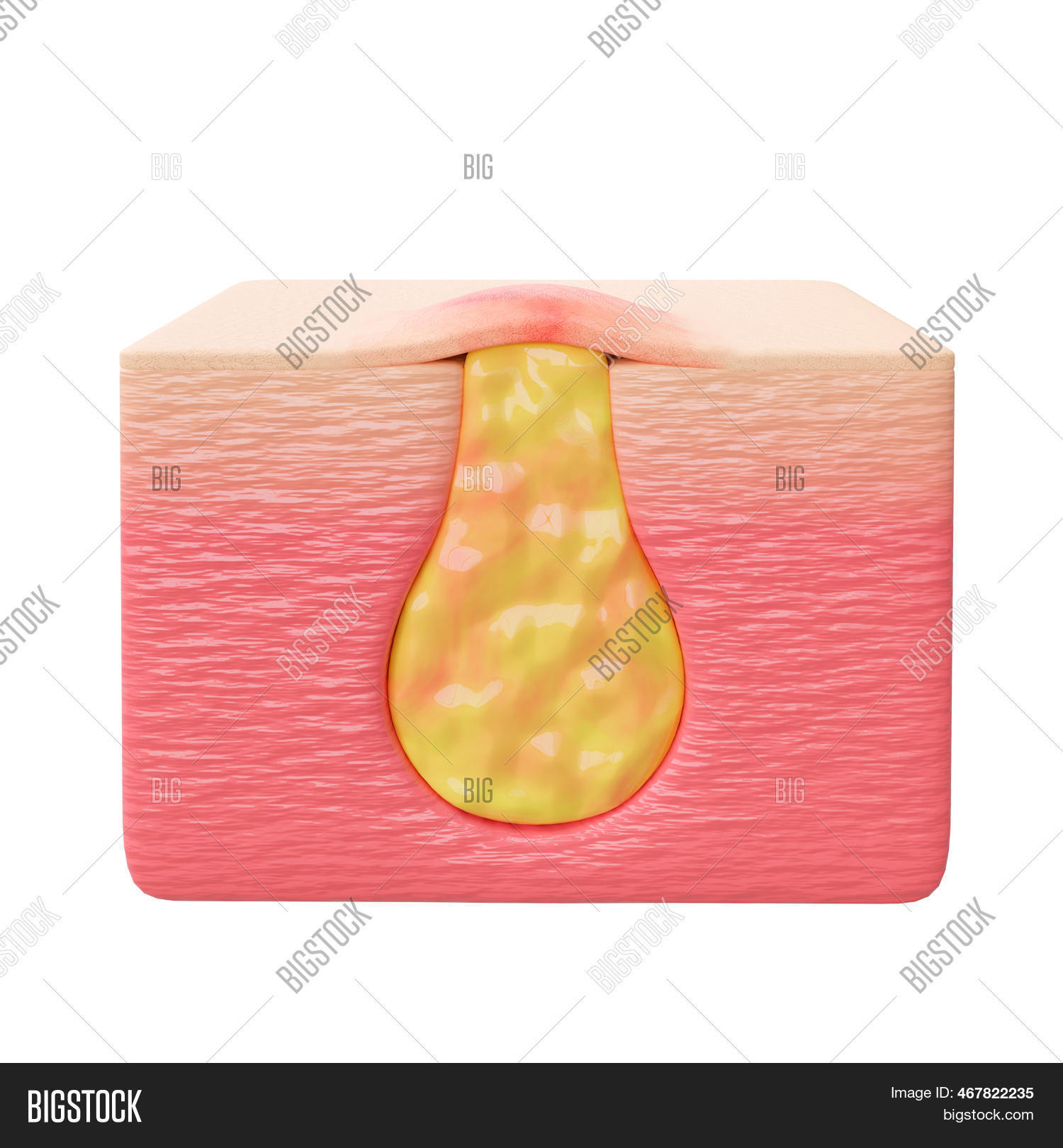 Acne Inflammatory Image & Photo (Free Trial) | Bigstock