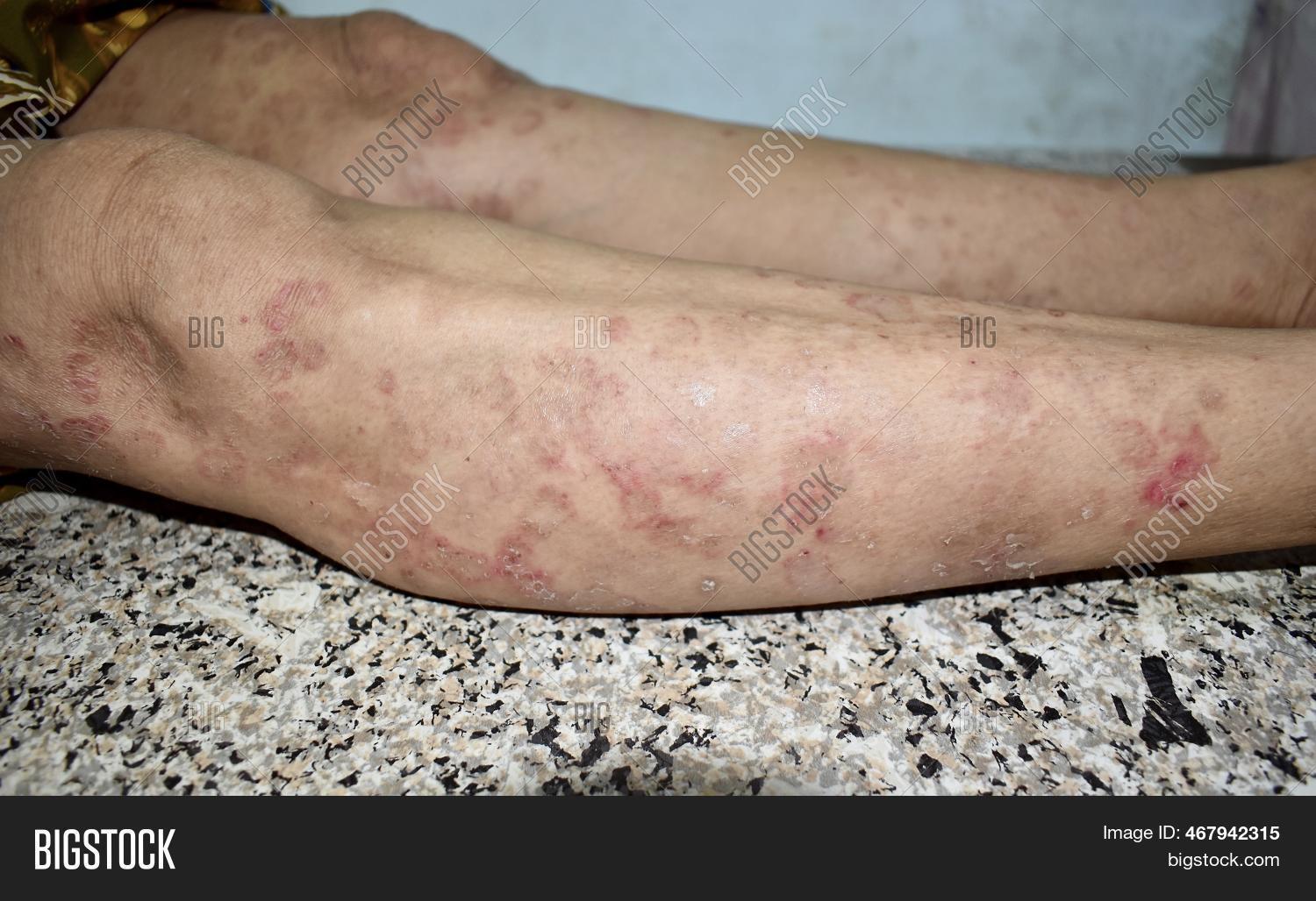 Fungal Infection Image & Photo (Free Trial) | Bigstock