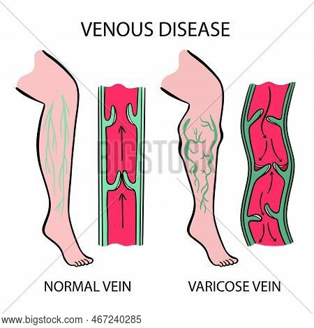 Venous Disease Vector & Photo (Free Trial) | Bigstock