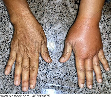 Unilateral Edema Upper Image & Photo (Free Trial) | Bigstock