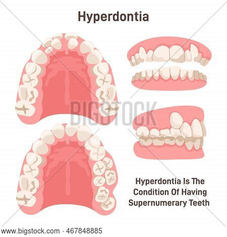 Teeth Upper Lower Jaw Vector & Photo (Free Trial) | Bigstock