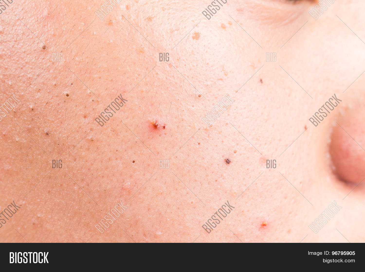 Close Pimple Image & Photo (Free Trial) | Bigstock