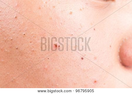 Close Pimple Image & Photo (Free Trial) | Bigstock