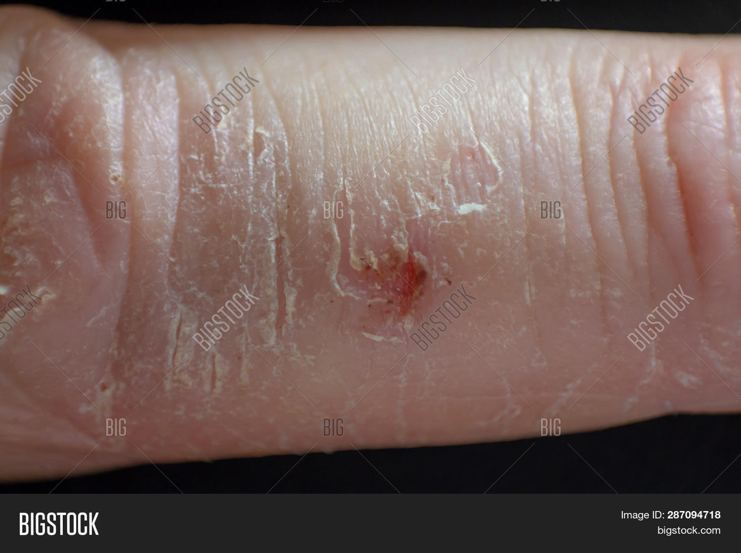 Hand Dermatitis. Hand Image & Photo (Free Trial) | Bigstock