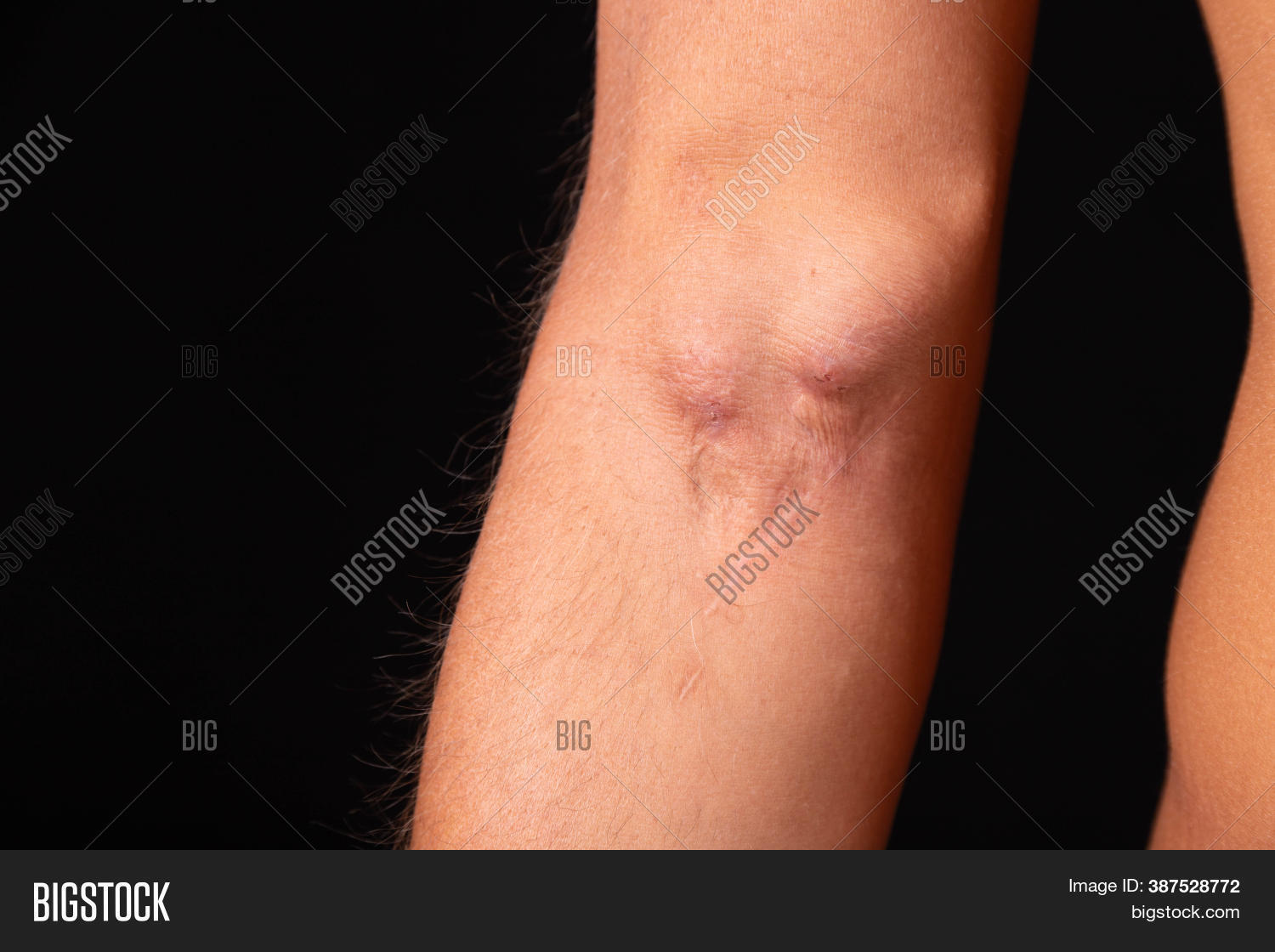 Fistula On Arm Result Image & Photo (Free Trial) | Bigstock