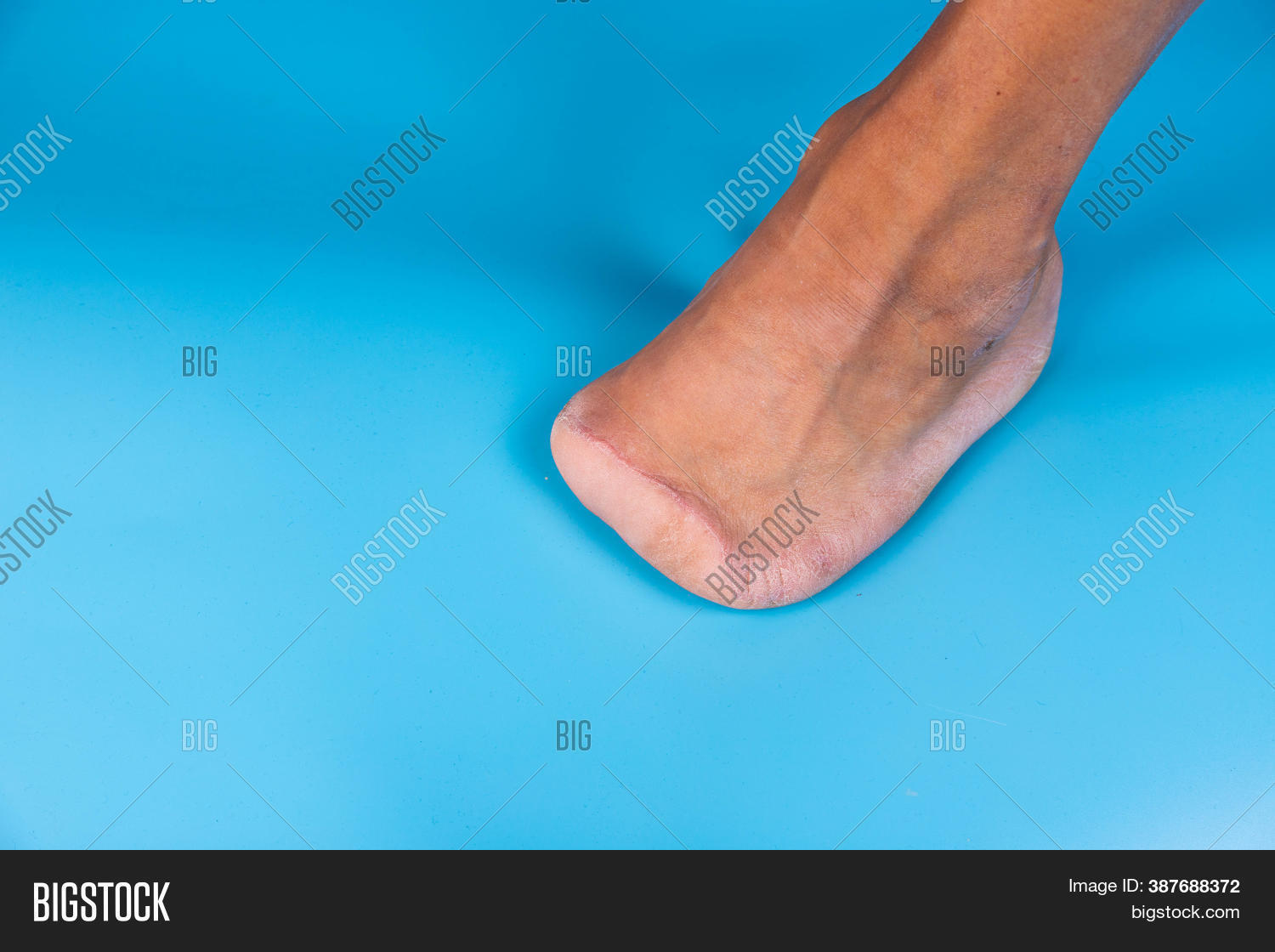 Amputation All Toes Image & Photo (Free Trial) | Bigstock