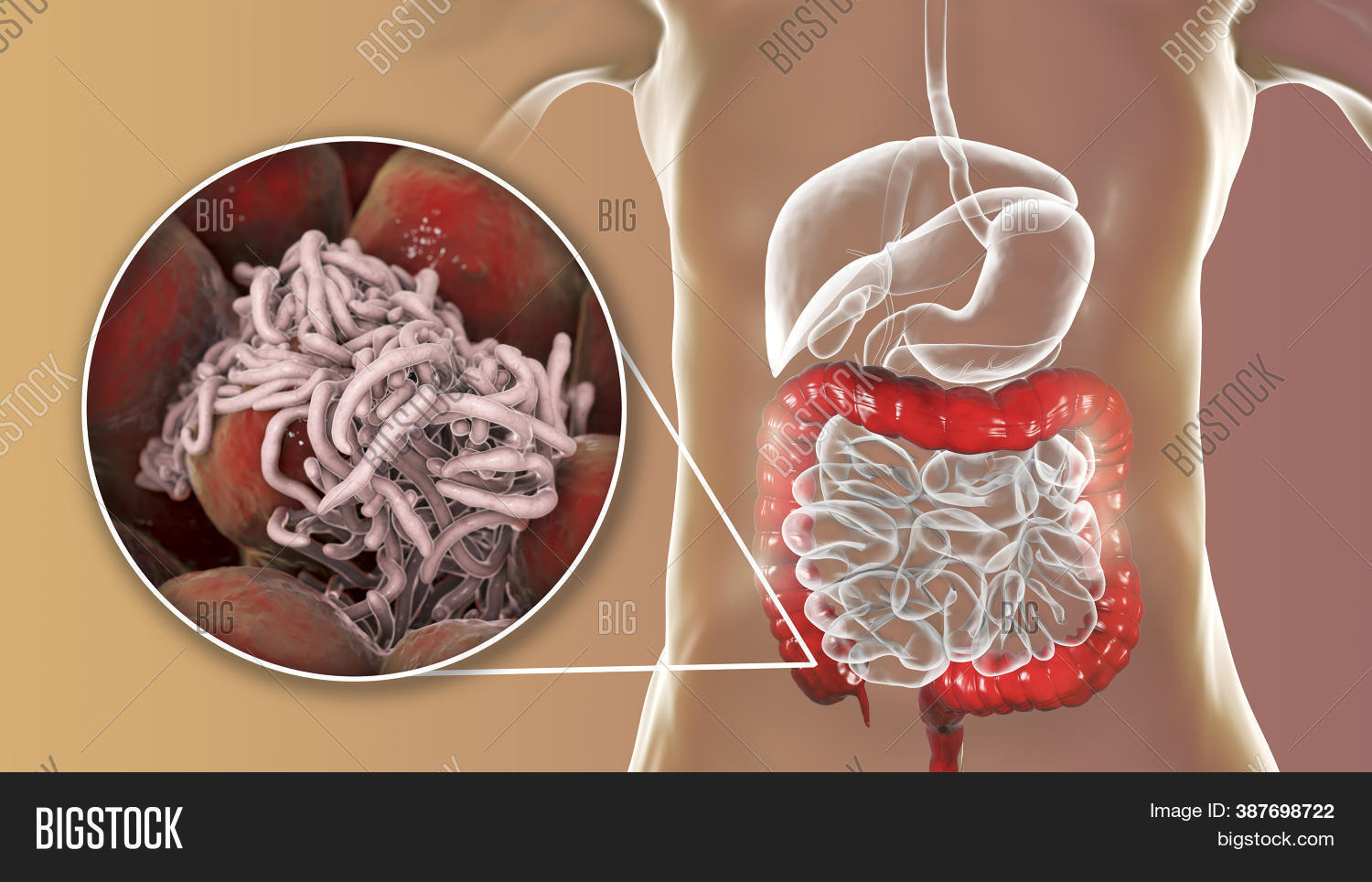 Parasitic Worms Human Image & Photo (Free Trial) | Bigstock