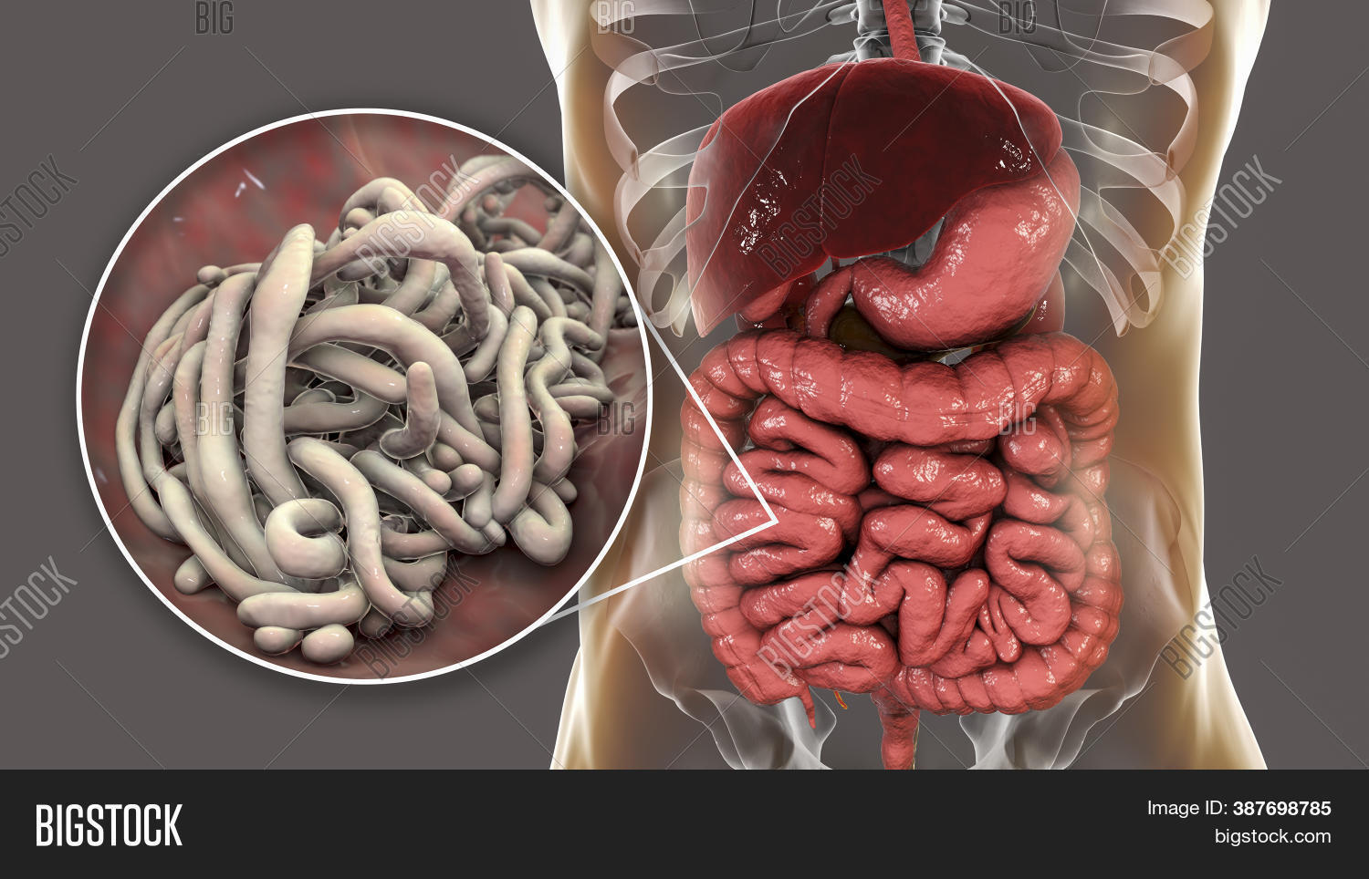 Parasitic Worms Human Image & Photo (Free Trial) | Bigstock