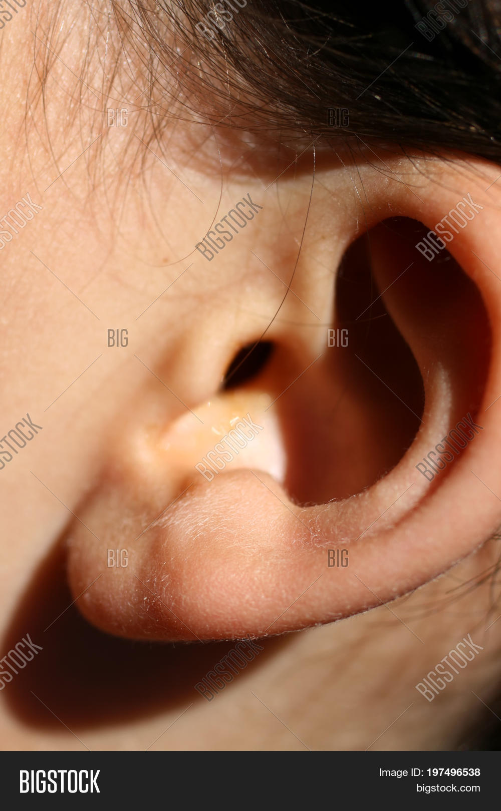 Deformed Ear. Abnormal Image & Photo (Free Trial) | Bigstock