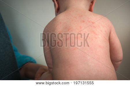 Allergies Pimples On Image & Photo (Free Trial) | Bigstock