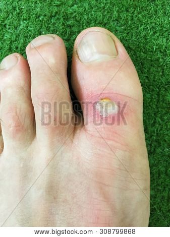 Close Top Painful Big Image & Photo (Free Trial) | Bigstock