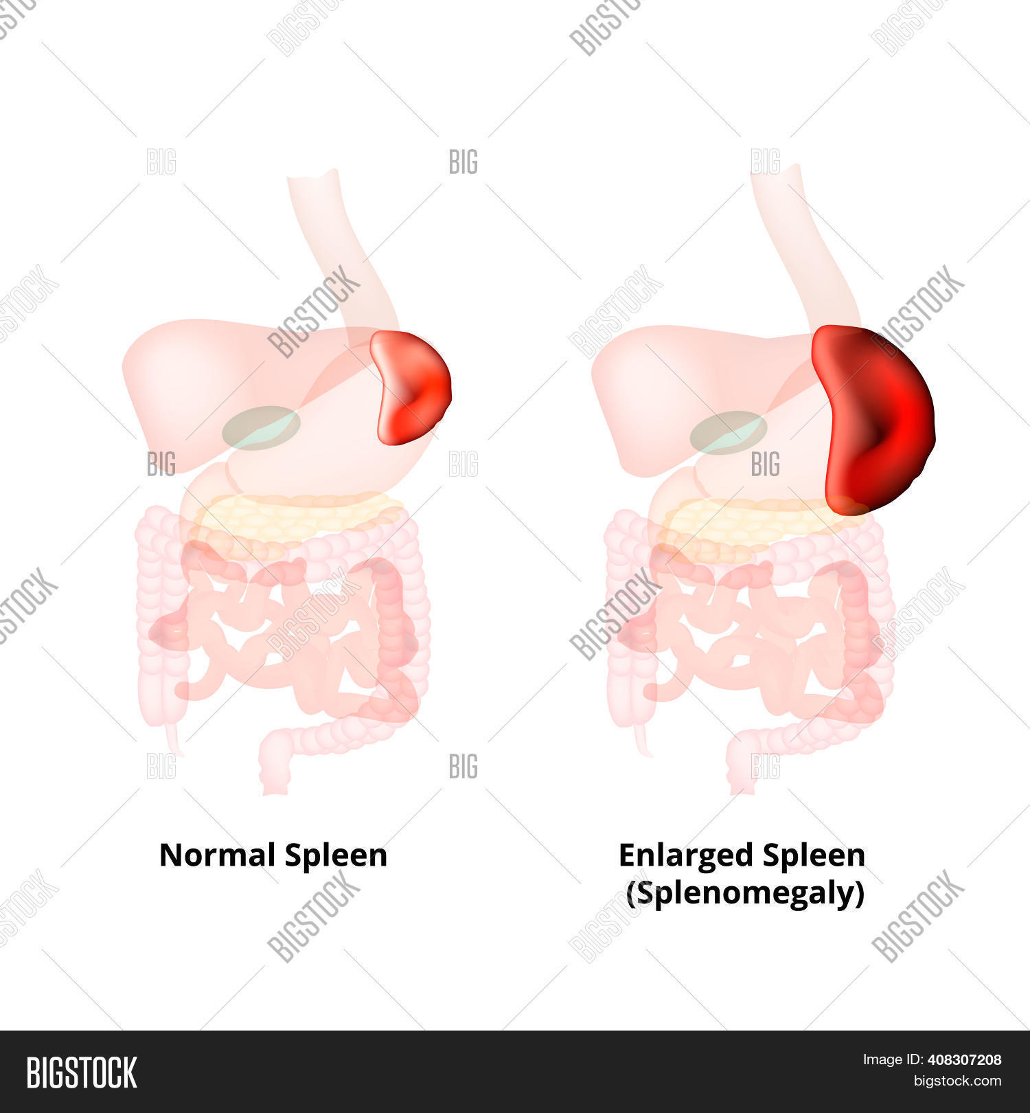 Splenomegaly Spleen. Image & Photo (Free Trial) | Bigstock