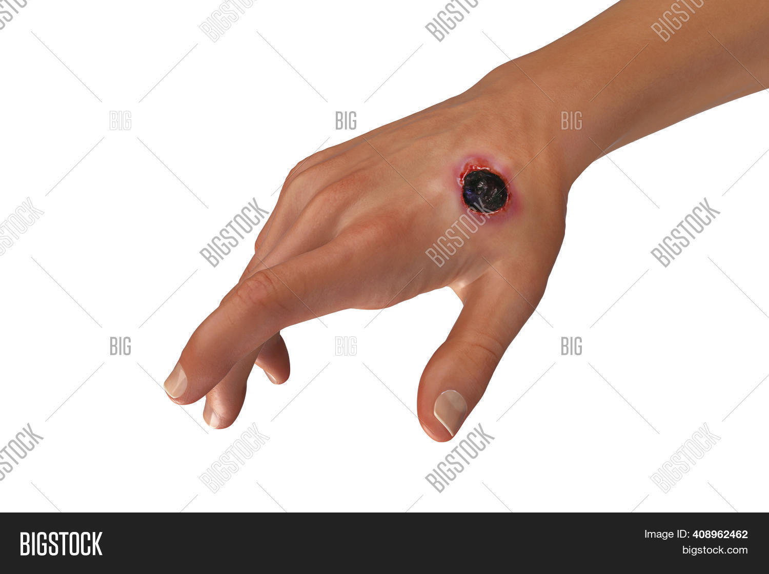 Cutaneous Anthrax, Image & Photo (Free Trial) | Bigstock