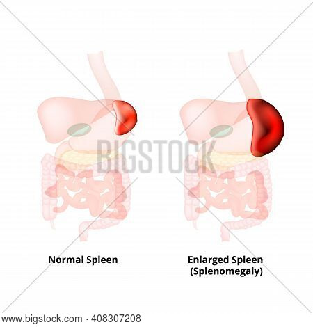 Splenomegaly Spleen. Image & Photo (Free Trial) | Bigstock