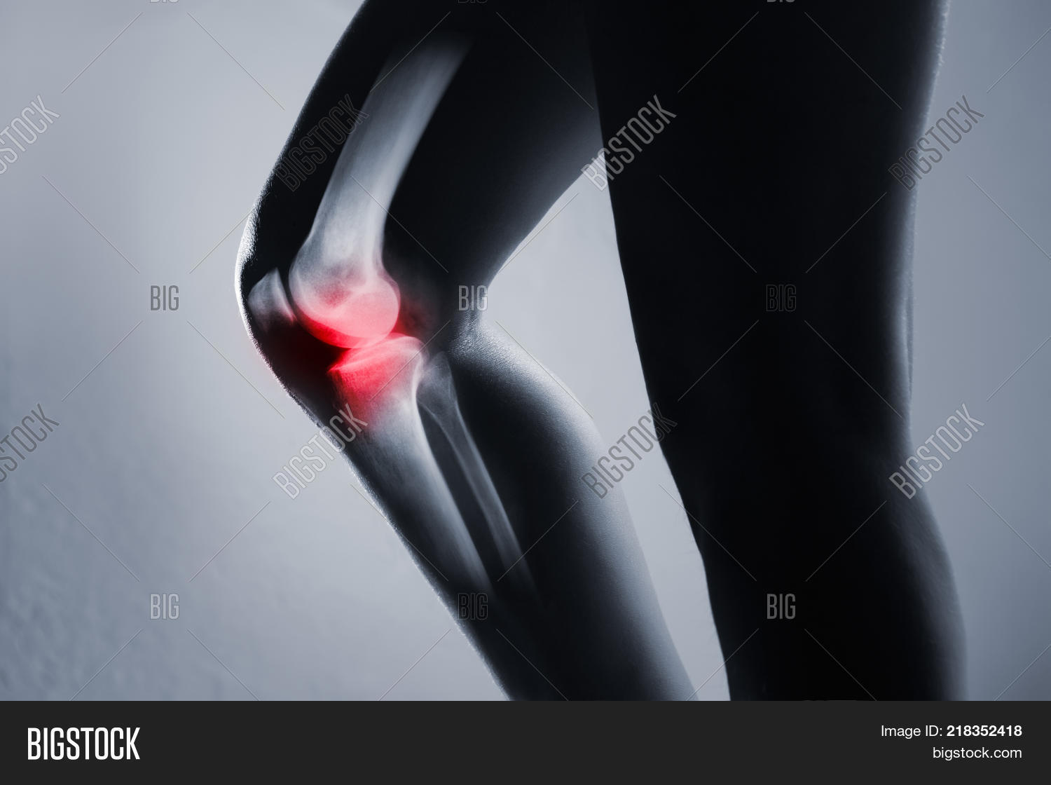 Human Knee Joint Leg X Image & Photo (Free Trial) | Bigstock