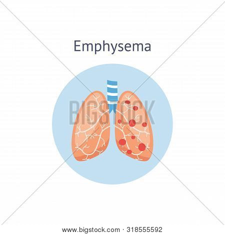 Emphysema Chronic Vector & Photo (Free Trial) | Bigstock