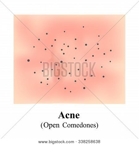 Acne, Open Comedones Vector & Photo (Free Trial) | Bigstock