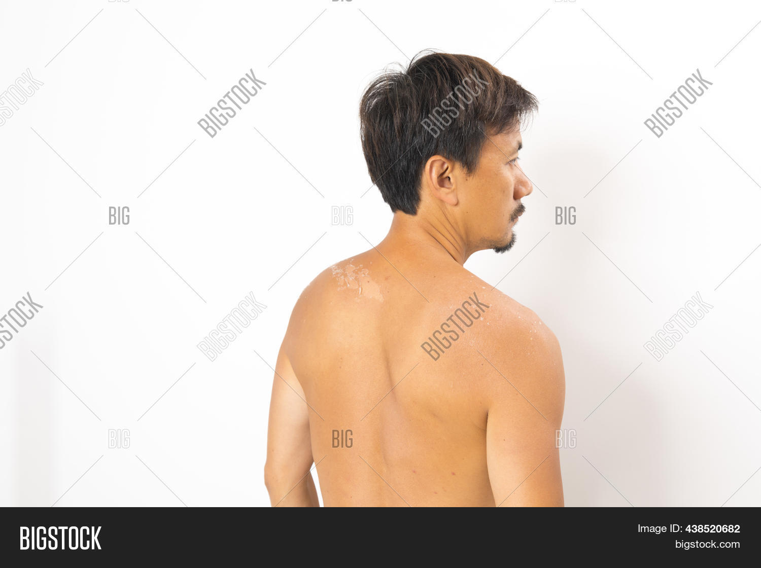 Back Man Skin Burned Image & Photo (Free Trial) | Bigstock