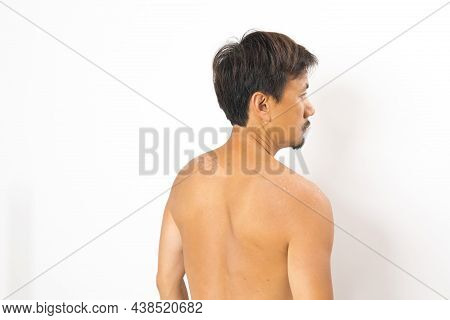 Back Man Skin Burned Image & Photo (Free Trial) | Bigstock