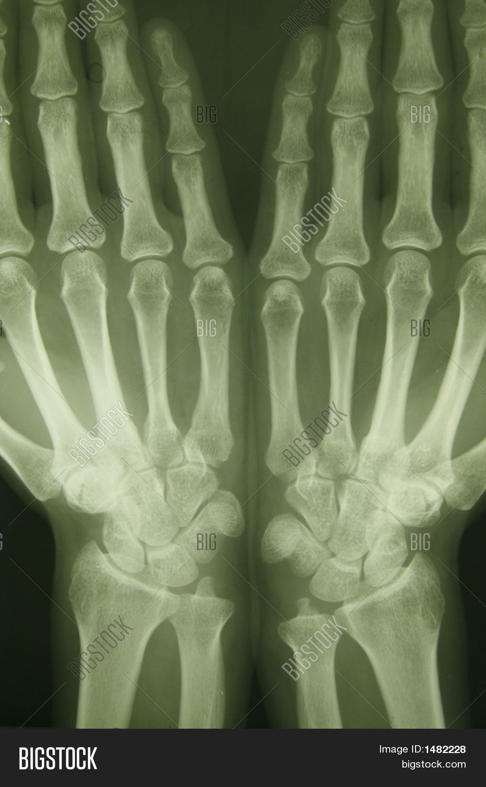 X-Ray Photo Image & Photo (Free Trial) | Bigstock