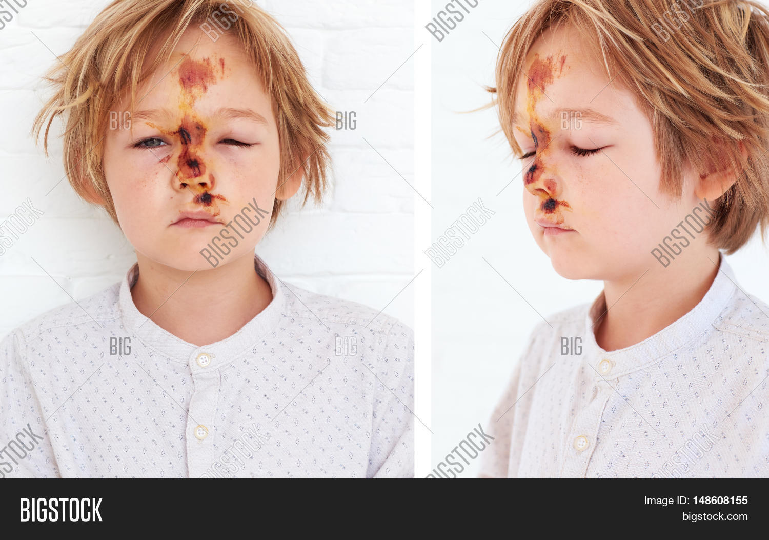 Soft Tissue Contusion Image & Photo (Free Trial) | Bigstock