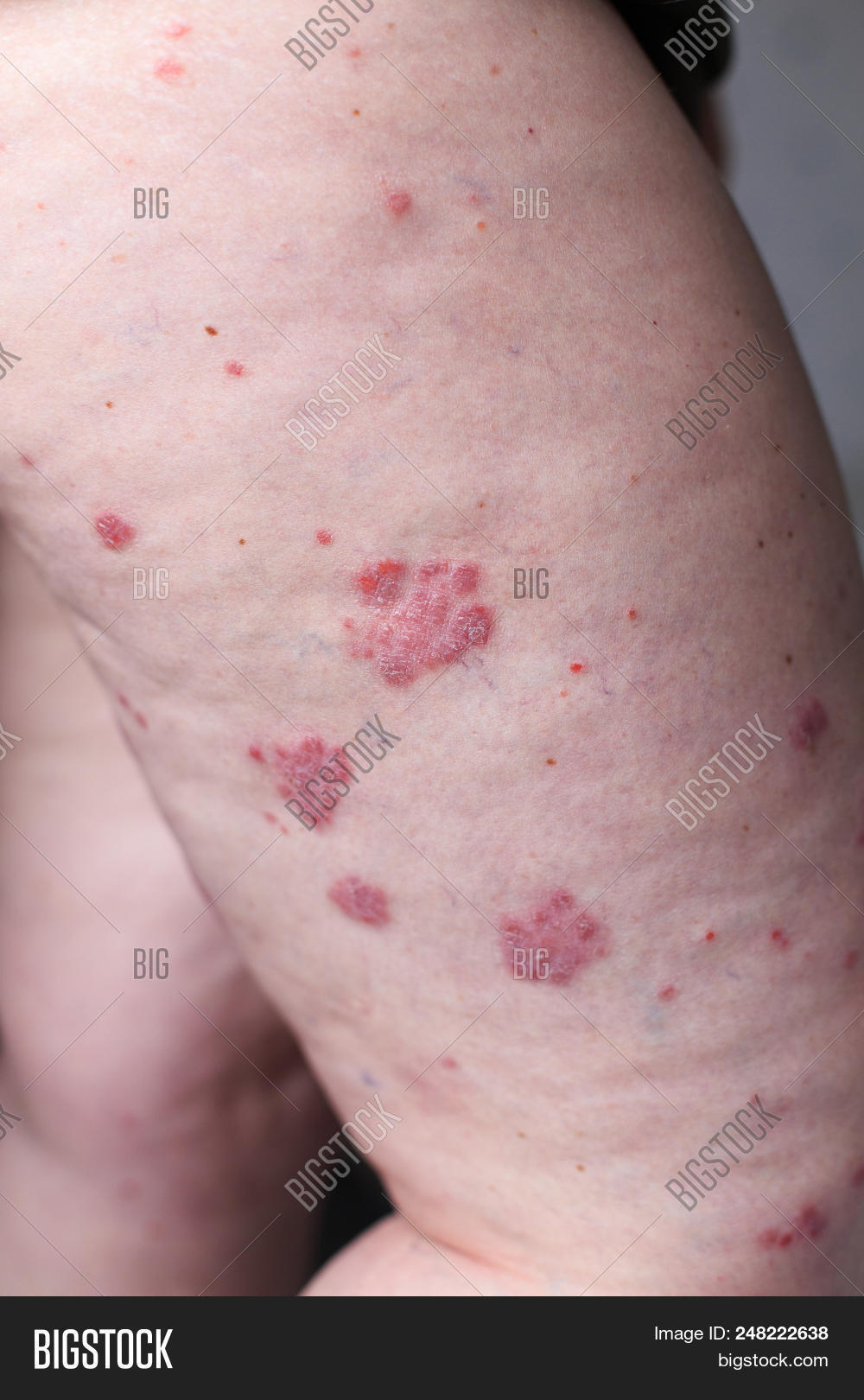 Psoriasis Vulgaris Image & Photo (Free Trial) | Bigstock