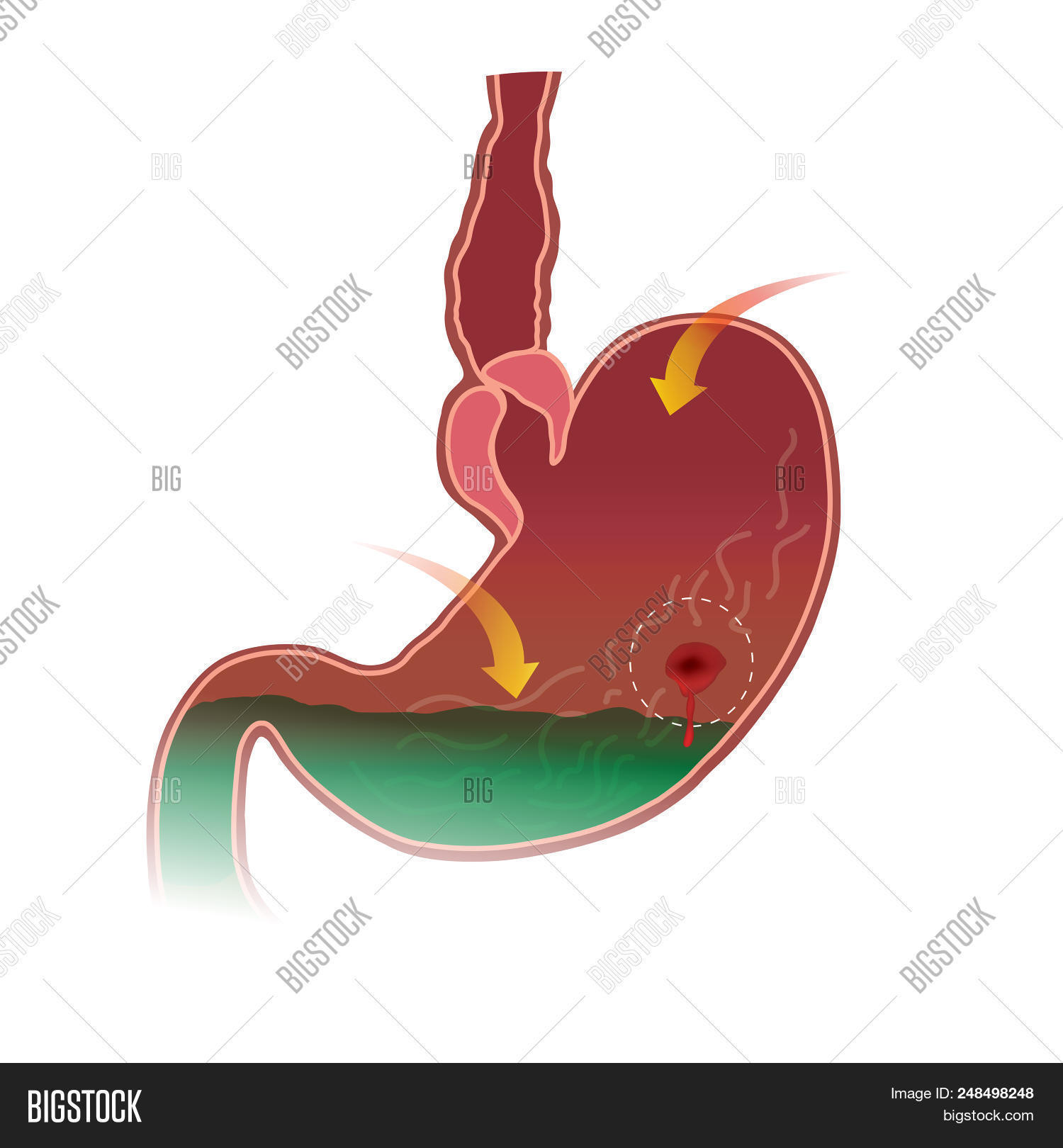 Stomach Peptic Ulcer. Image & Photo (Free Trial) | Bigstock