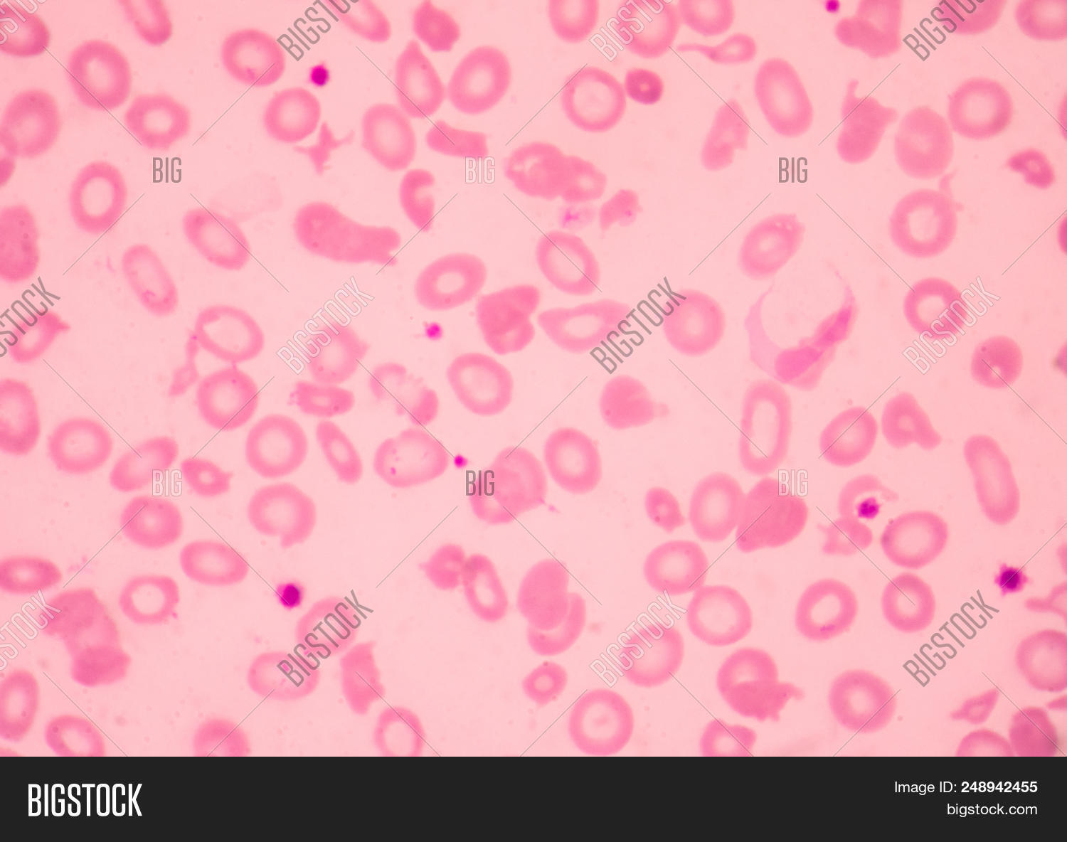 Thalassemia Blood Image & Photo (Free Trial) | Bigstock