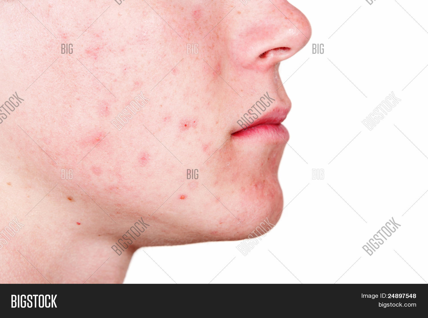 Acne Image & Photo (Free Trial) | Bigstock