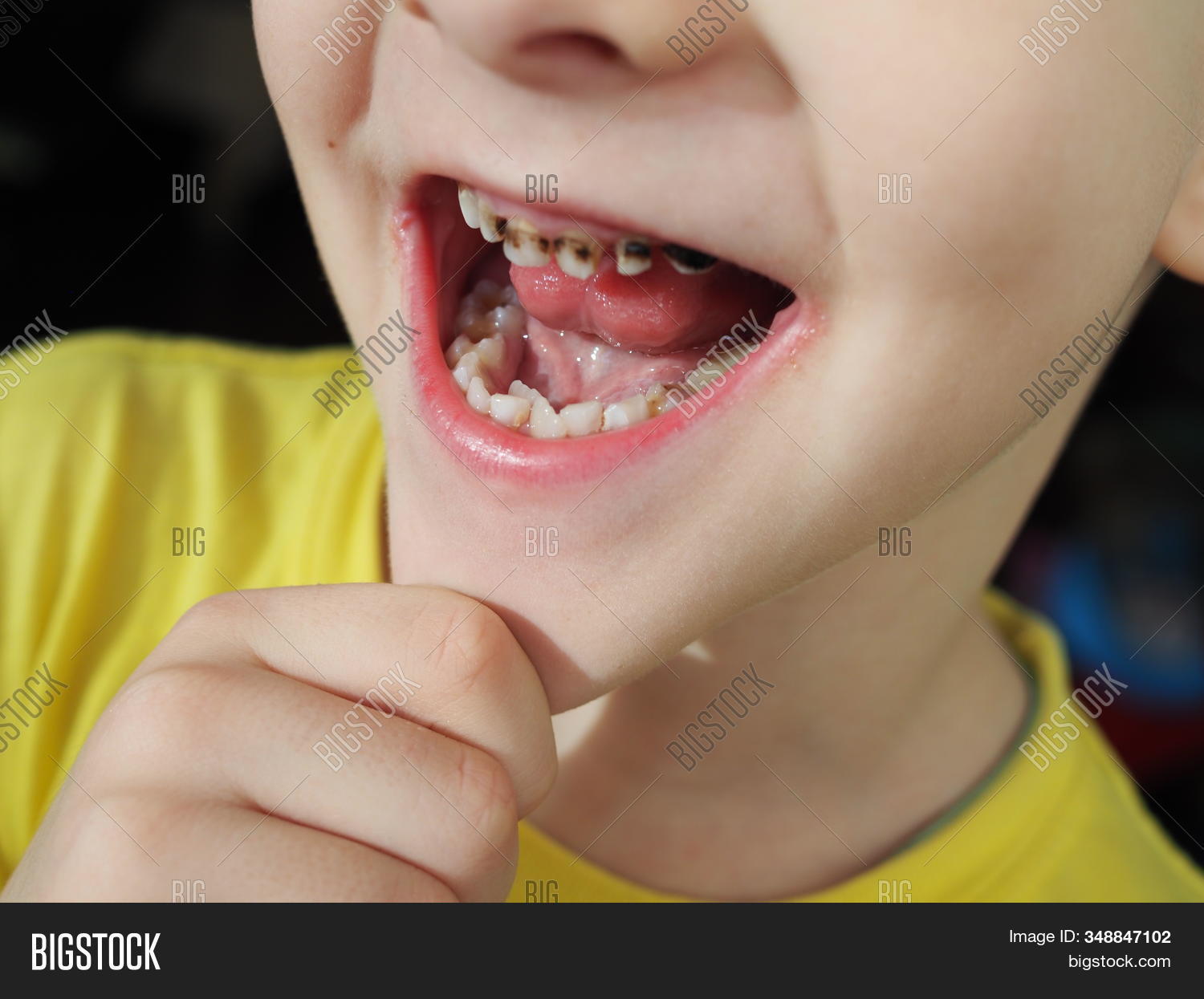 Abnormal Boy Tooth. Image & Photo (Free Trial) | Bigstock