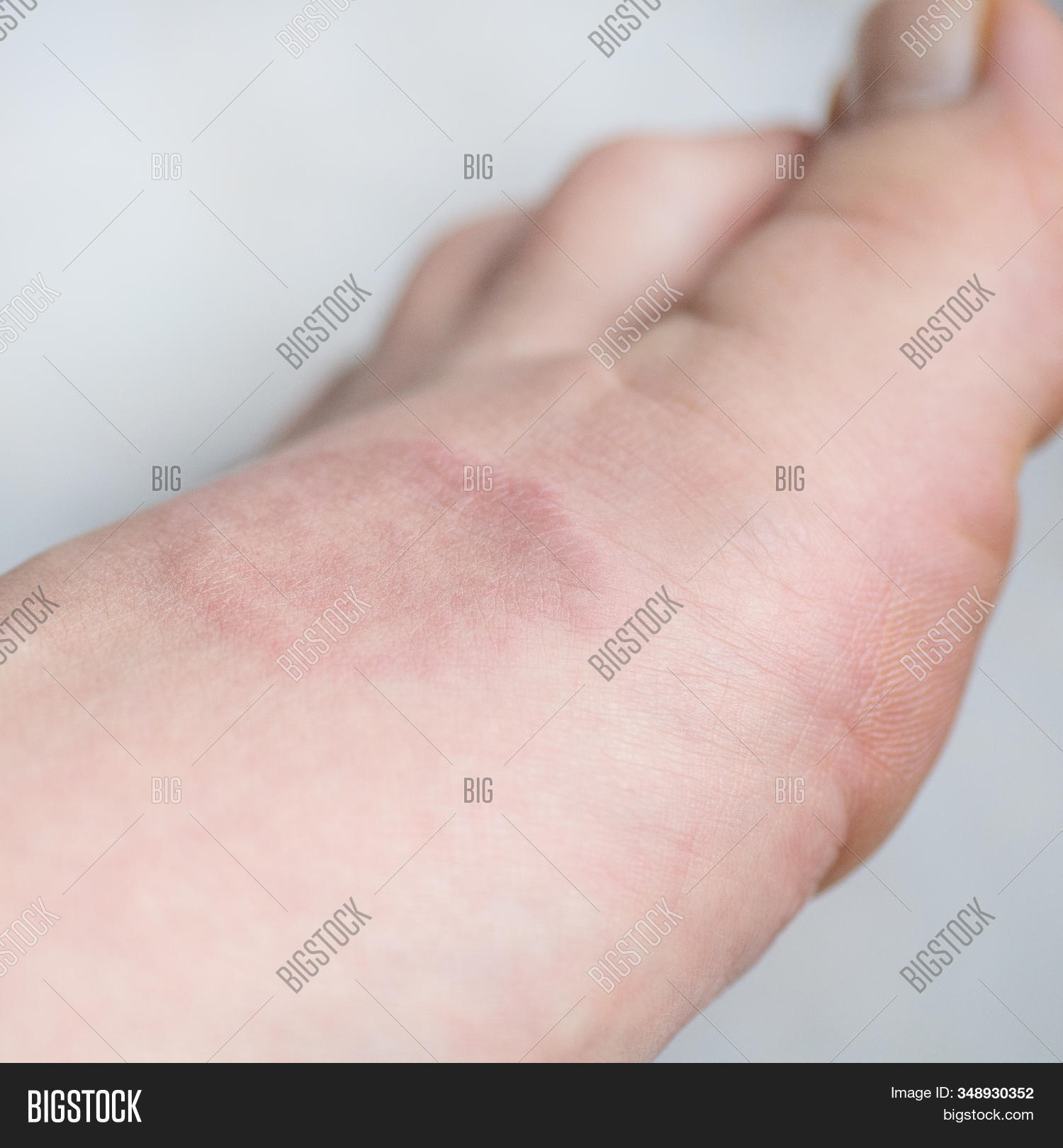 Human Leg Granuloma Image & Photo (Free Trial) | Bigstock